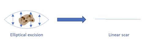 Skin Biopsies Coogee Wa — The Skin Cancer Centre Coogee