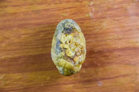Premium Photo Large Gallstone Gall Bladder Stone The Result Of Gallstones