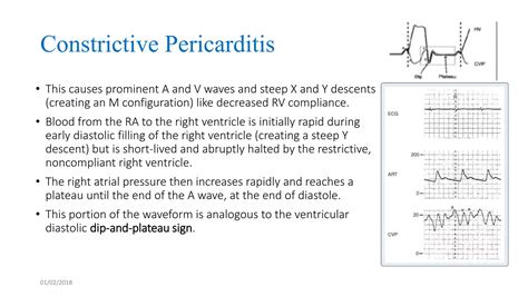 Central Venous Pressure Monitoring Iactacon 2018 Pptx