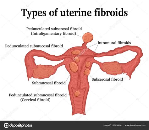 Types Of Uterine Fibroids Stock Vector Image By © 167036896