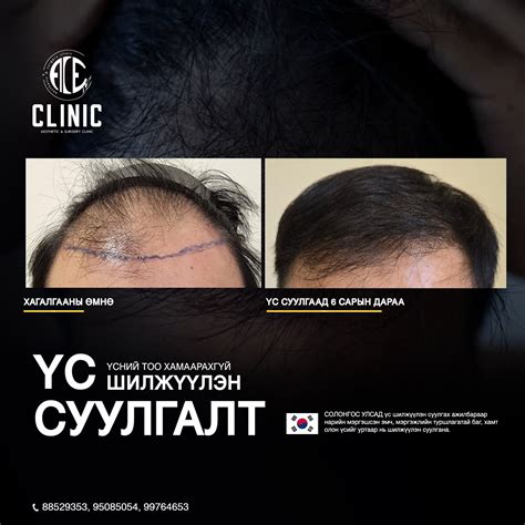 Ace НАСАН ТУРШИД УРГАХ ҮС ШИЛЖҮҮЛЭН СУУЛГАЛТ 👨 Уртаар нь суулгана