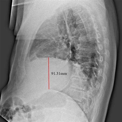 Erect Right Lateral Cxr Of Case 1 Taken Two Days After Admission The Download Scientific