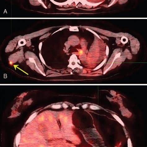 Pathological Results Of Subcutaneous Nodules Were Observed Under A