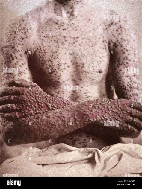 Smallpox Pustules