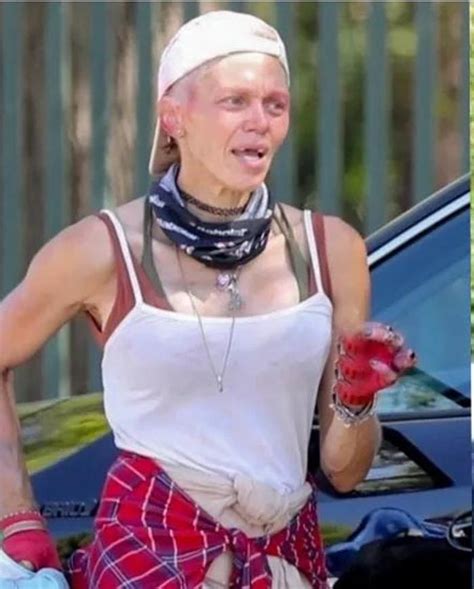 Sokakta Yaşayıp çöpten Yemek Topluyor Loni Willison ön Dişleri Dökülmüş Halde Görüntülendi