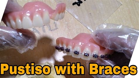 Pustiso With Braces And Acrylic Dentures Youtube