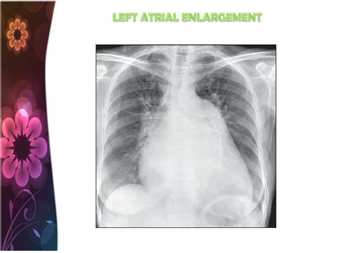 Ppt Chest Radiology Powerpoint Presentation Free Download Id2254706