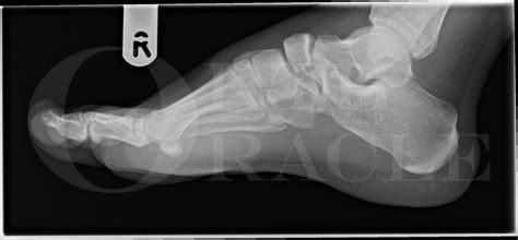 Internal Fixation Of Fracture Dislocation Of The Navicular Surgical