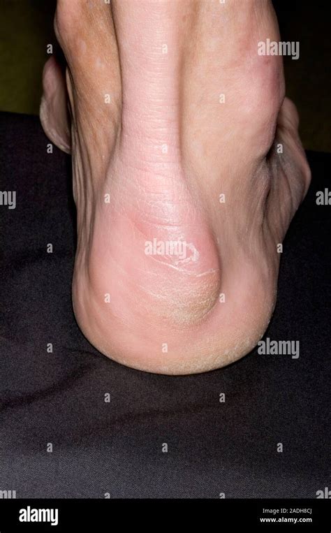 Bone Spur Caused By Arthritis Protruding From The Heel Of A 62 Year