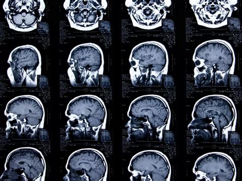 Zirbeldrüse Zyste Ursachen Symptome Diagnose Behandlung