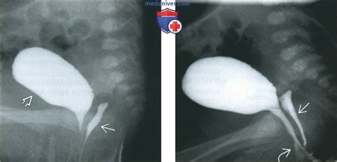 Лучевые признаки неопределенного пола