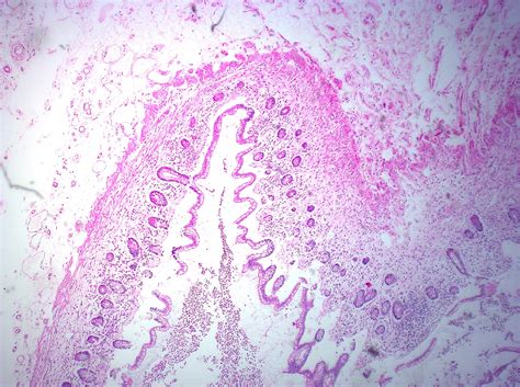 Pathology Outlines Sclerosing Peritonitis