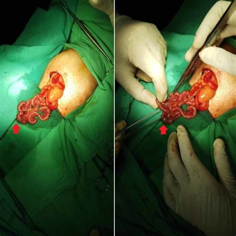 Exploratory Laparotomy Showing A Dilated Duodenum And Proximal Jejunal