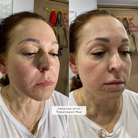Nasolabial Folds And Marionette Lines Dermal Fillers Evgenia