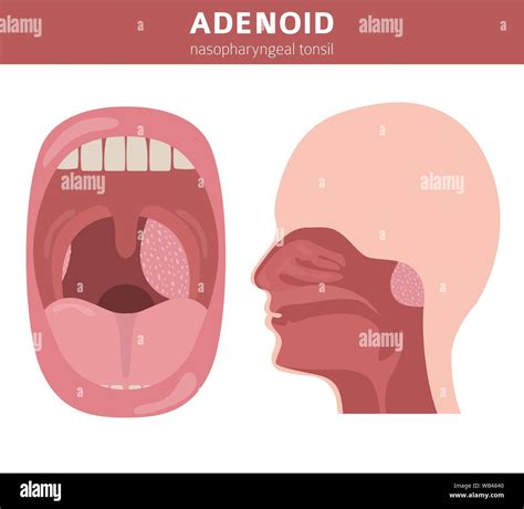 Nasal And Throat Nasopharynx Diseases Adenoids Diagnosis And