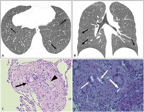 Non Infectious Granulomatous Lung Disease Imaging Findings With