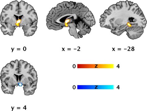 A Neural Circuit Encoding Sexual Preference In Humans PMC