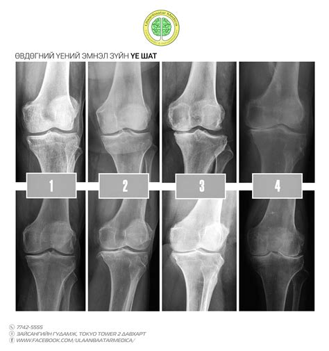 ӨВДӨГНИЙ ҮЕ СОЛИУЛАХ БОЛ ЭЦСИЙН ШАТНЫ ЭМЧИЛГЭЭ ЮМ Өвдөгний үений үрэвслийн хүндрэлийн үе шатыг