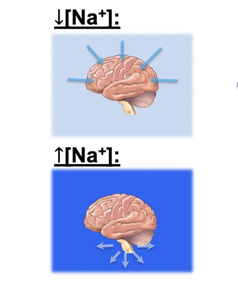 Hyponatremia Usmle Rx