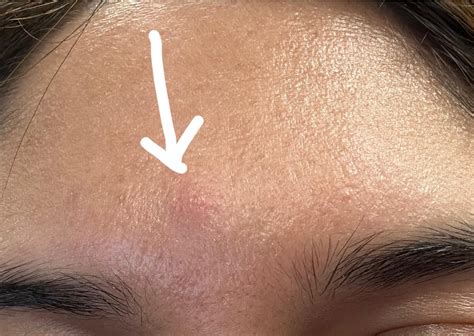 What Should I Do To Treat This Before It Develops Into A Big Red Pimple