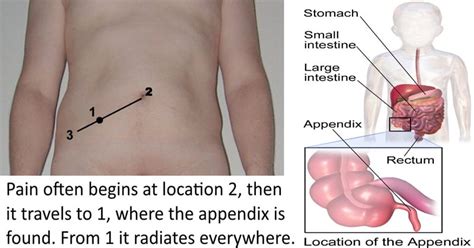 Ways To Soothe And Prevent Appendicitis Pain