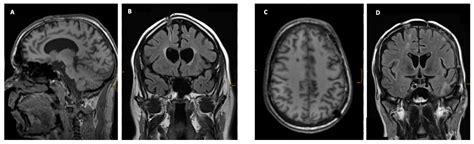 Integra Neurosciences Licox Catheter System