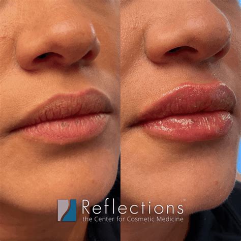 Lip Filler Before And After Photos And Results The Daily Glimmer