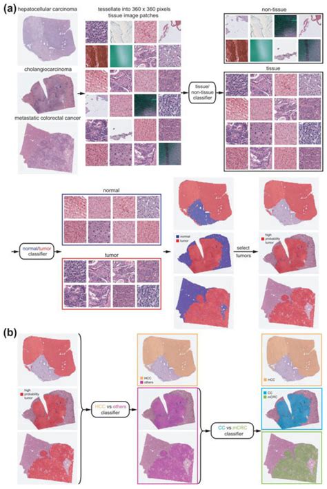 Deep Learning For The Pathologic Diagnosis Of Hepatocellular Carcinoma