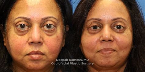 Orbital Decompression Center For Eye And Facial Plastic Surgery