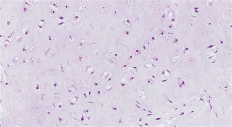 Chondroid Mypathologyreport