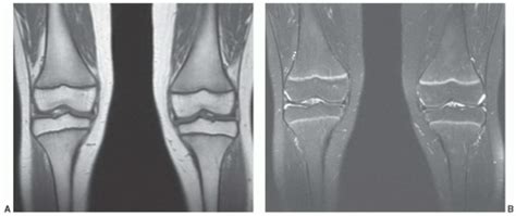 Diffuse Marrow Diseases Musculoskeletal Key Diffuse Marrow Diseases Musculoskeletal Key