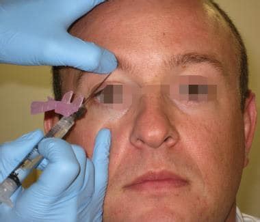 Supraorbital Nerve Block Overview Indications Contraindications