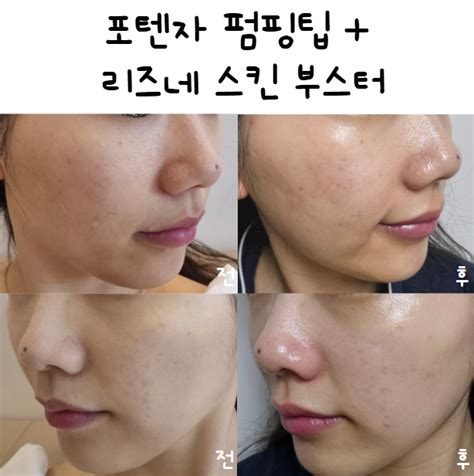 강남역 포텐자 레이저 펌핑팁 리즈네 스킨 부스터 효과 부작용까지 정리 네이버 블로그
