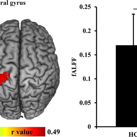 The Tract Based Spatial Statistics Tbss Analysis Identified