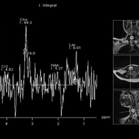 Magnetic Resonance Spectroscopy Of Nodule In Right Lobe Of Thyroid Download Scientific Diagram