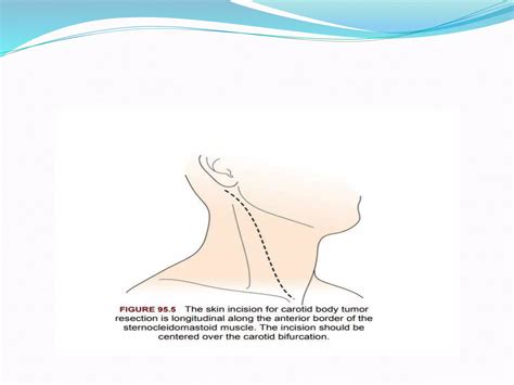 Carotid Body Tumorpptx Heart And Cardiovascular Diseases Diseases And Conditions