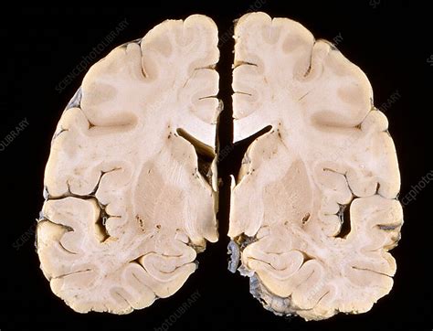 Nipah Virus Infection Brain Specimen Stock Image C036 0023