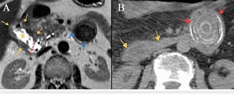 A Axial T2 Weighted Mri Section Prominently Thickened Gallbladder Download Scientific