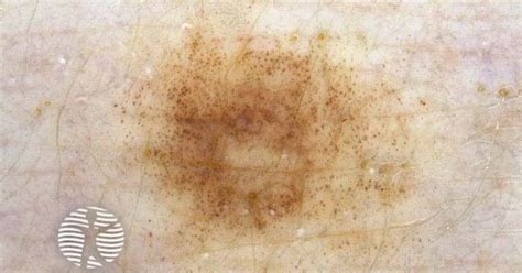 Melanocytic Naevus Image