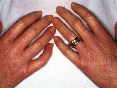 Scleroderma Types Pictures And Symptoms