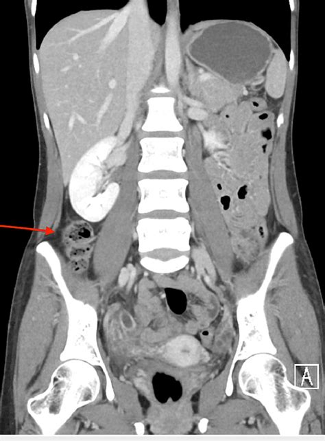 CT Abdomen Pelvis With Contrast Showing A Dilated Appendix Red Arrow