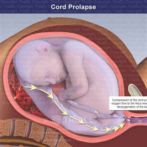 Umbilical Cord Prolapse