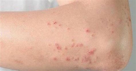 Alergie Cu Bubițe Mici Roșii Când Apar Erupțiile Cutanate