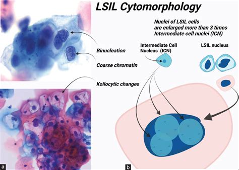 Squamous Intraepithelial Lesions Sil Lsil Hsil Ascus Asc H Lsil H