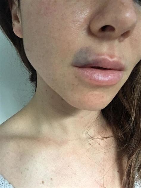 What To Put On Bruised Lips After Fillers