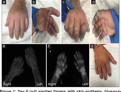 Severe Frostbite Amputation
