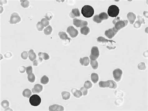 Myeloperoxydase Negative Staining Of Leukemic Blast Cells In Bone Download Scientific Diagram