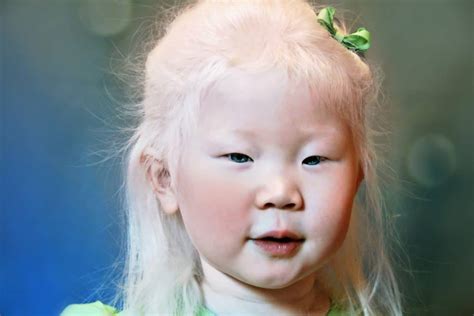 Orsaker Och Konsekvenser Av Albinism