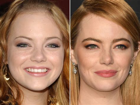 Emma Stone Before And After