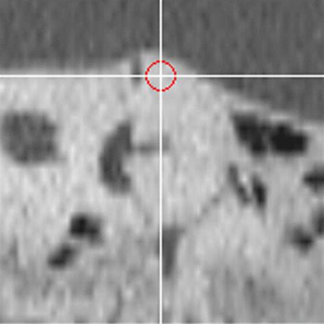 In The Temporal Bone Ct Measurements Were Taken From The Bone